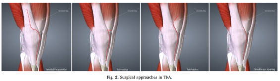 TKAの手術皮切り方法 midvastusとparapatellarとは | My Reha Note
