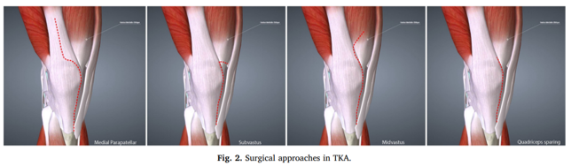 TKAの手術皮切り方法 midvastusとparapatellarとは | My Reha Note