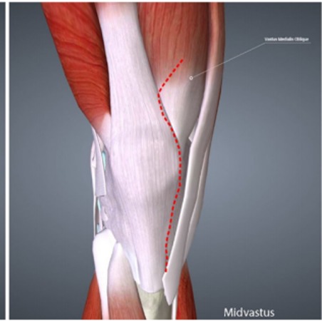 TKAの手術皮切り方法 midvastusとparapatellarとは | My Reha Note